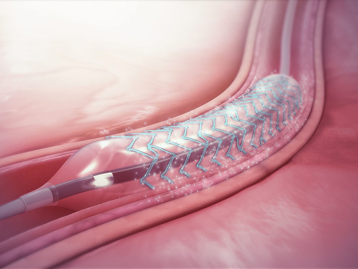 Cath PCI Archives ⋆ Quality Matters