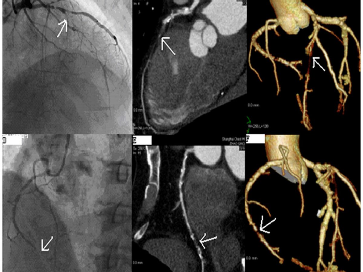 Cath PCI Archives ⋆ Quality Matters